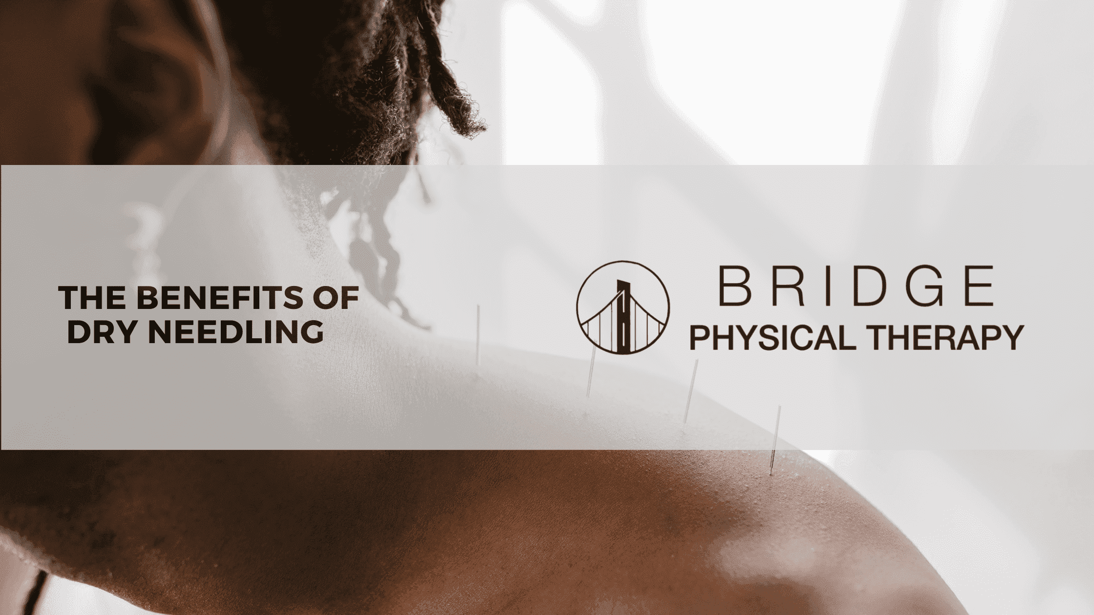 The Benefits of Dry Needling - Bridge Physical Therapy
